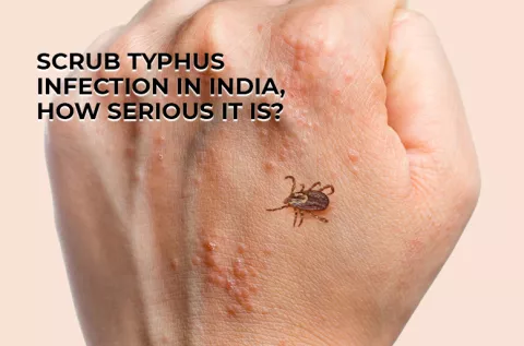 scrub typhus