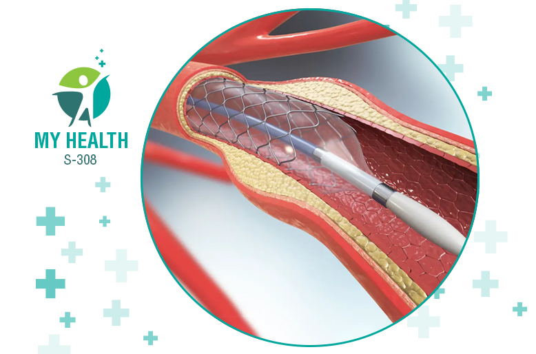 Angiogram Stents : an Overview