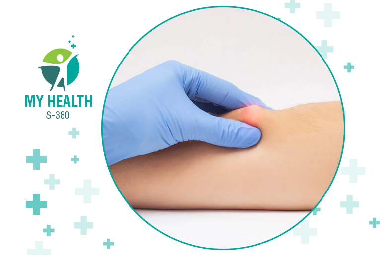 Red Light Therapy Lipoma | Shelly Lighting