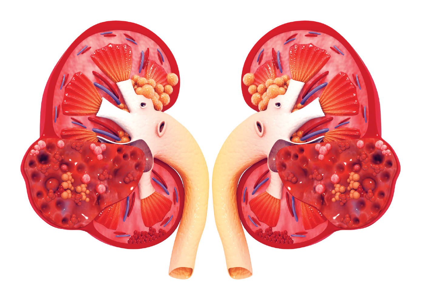 Kidney Diseases - An Overview