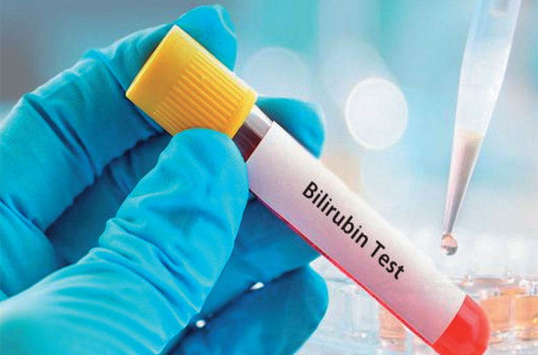 IMPORTANT POINTS TO KNOW ABOUT BILIRUBIN TESTING