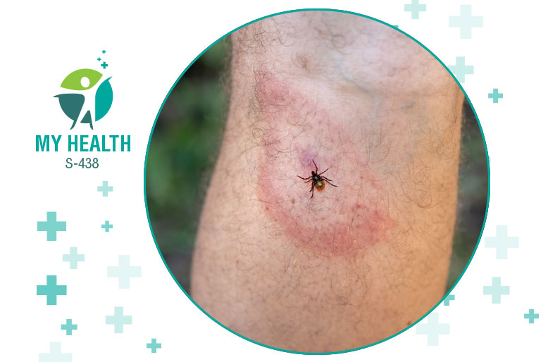 Unravelling the Mystery of Lyme Disease: Symptoms, Diagnosis, and Treatment Options