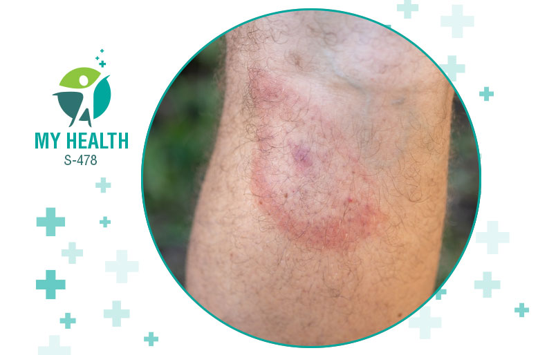 Kyasanur Forest Disease (KFD): Symptoms, Prevention, and Treatment ...